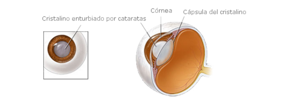 Cataract Surgery | Clínica Dr. Tirado