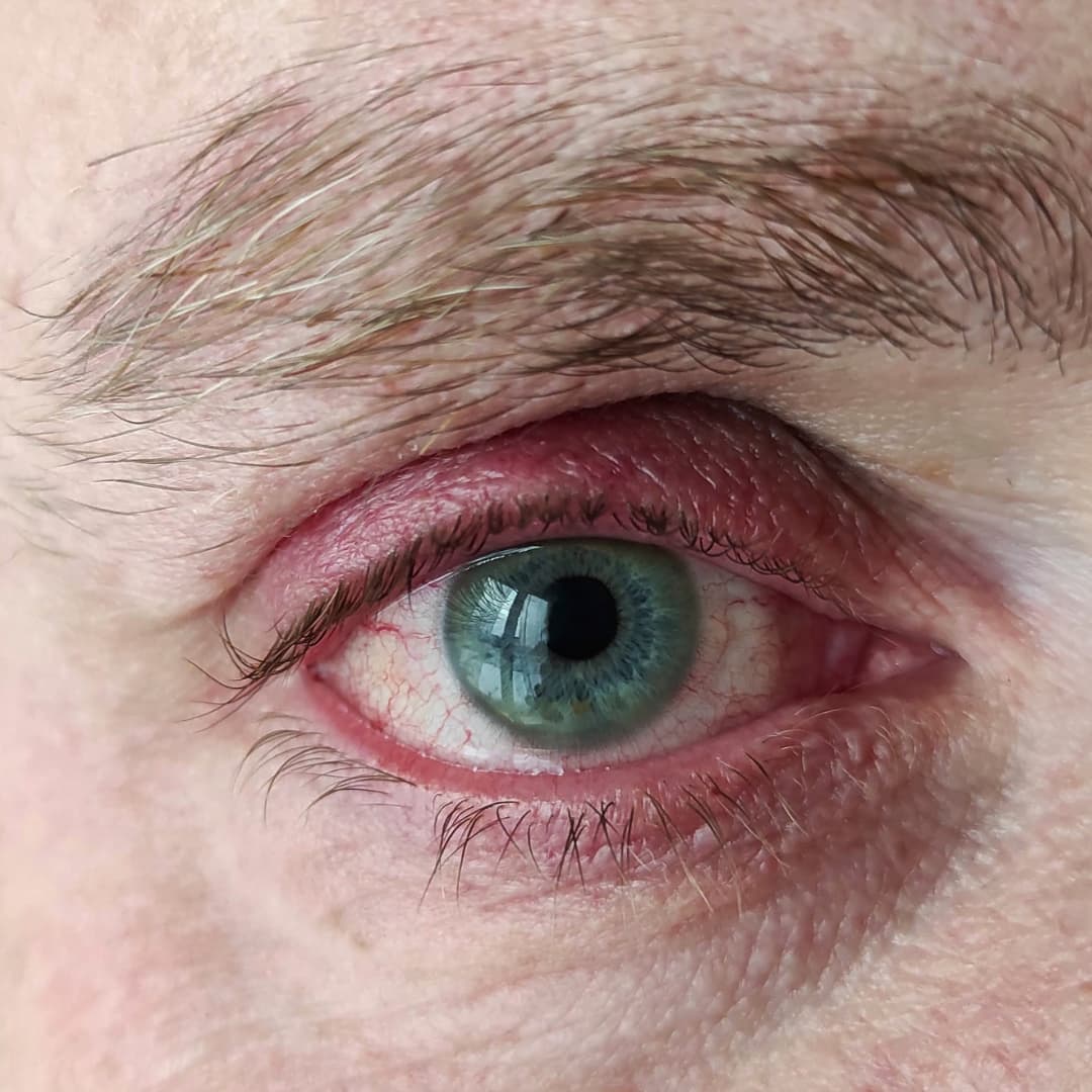 Desprendimiento de retina: ¿cómo es la operación? | Clínica Dr. Tirado